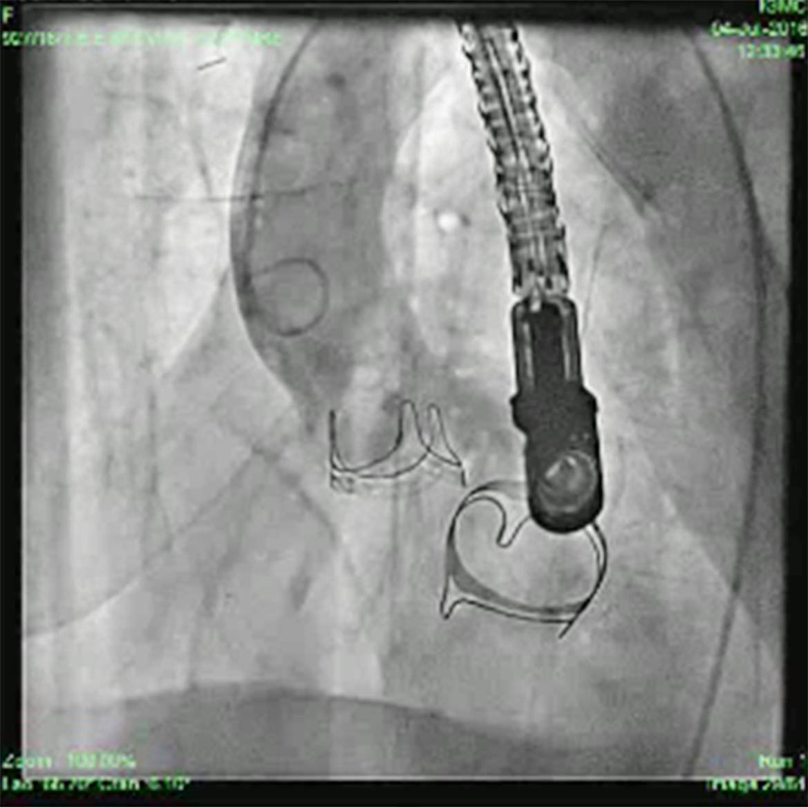 Device Closure of Aortic Paravalvular Leak – ASEAN Heart Journal