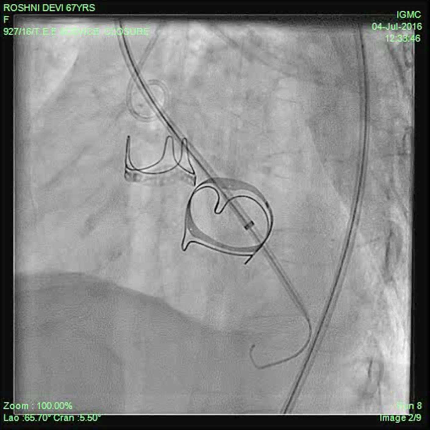 Device Closure of Aortic Paravalvular Leak – ASEAN Heart Journal
