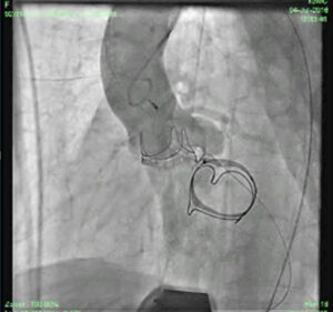 Device Closure of Aortic Paravalvular Leak – ASEAN Heart Journal