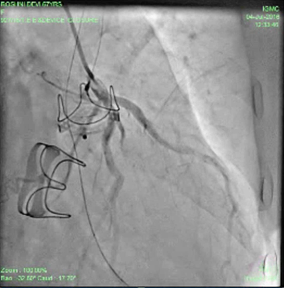 Device Closure of Aortic Paravalvular Leak – ASEAN Heart Journal