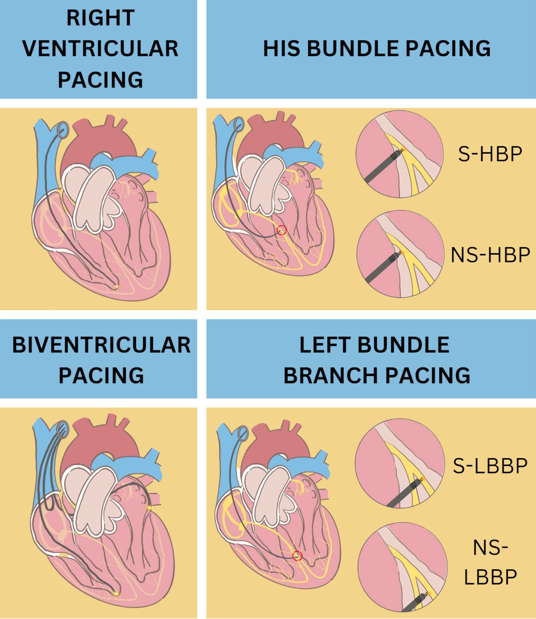 Pacing Induced Cardiomyopathy: Diagnosis and Management – ASEAN Heart ...