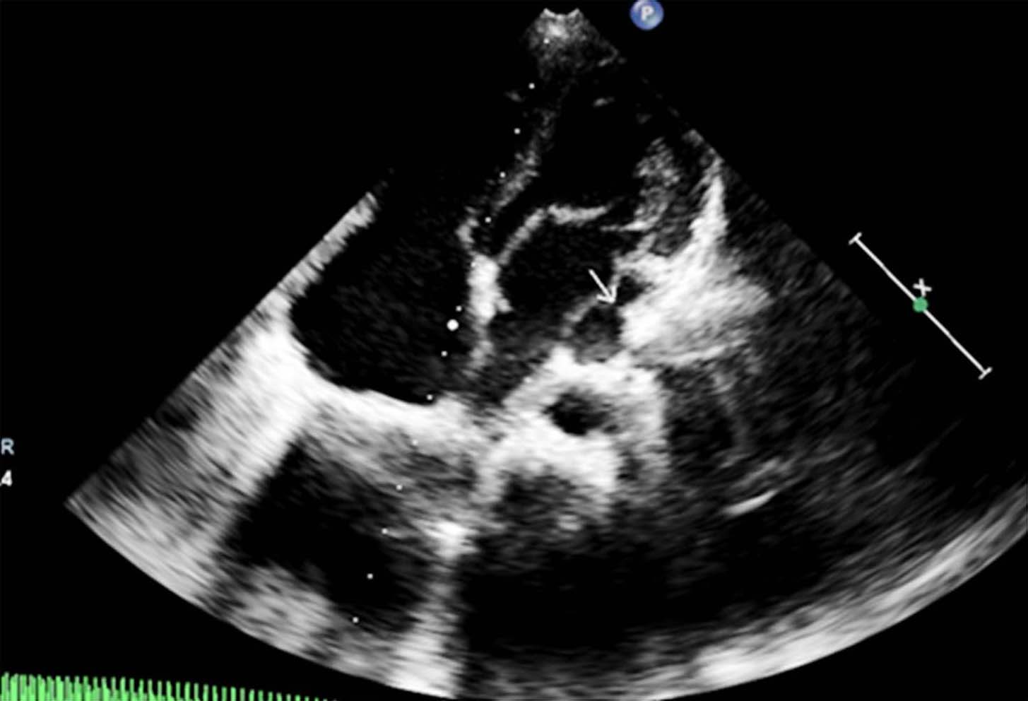 Device Closure of Left Circumflex Coronary Artery to Coronary Sinus ...