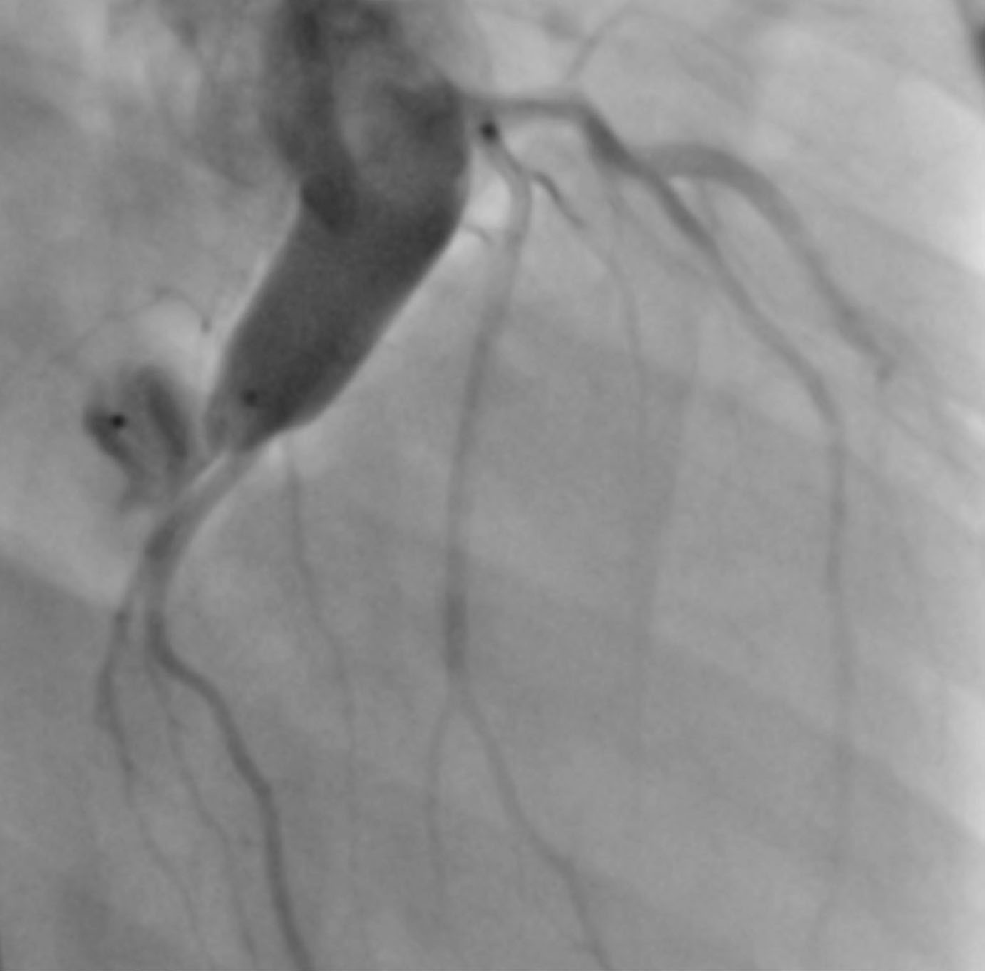 Device Closure of Left Circumflex Coronary Artery to Coronary Sinus ...