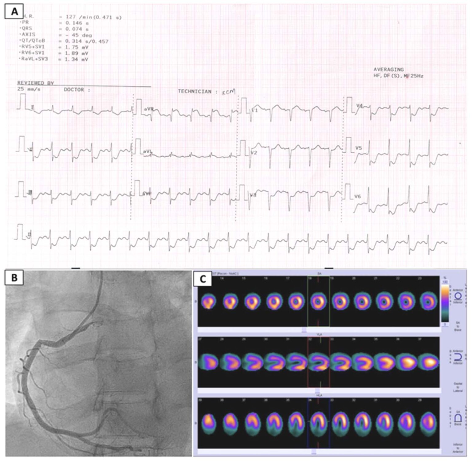STEMI and Thyroid Storm: A Case Report of Thyrotoxicosis-Induced ...