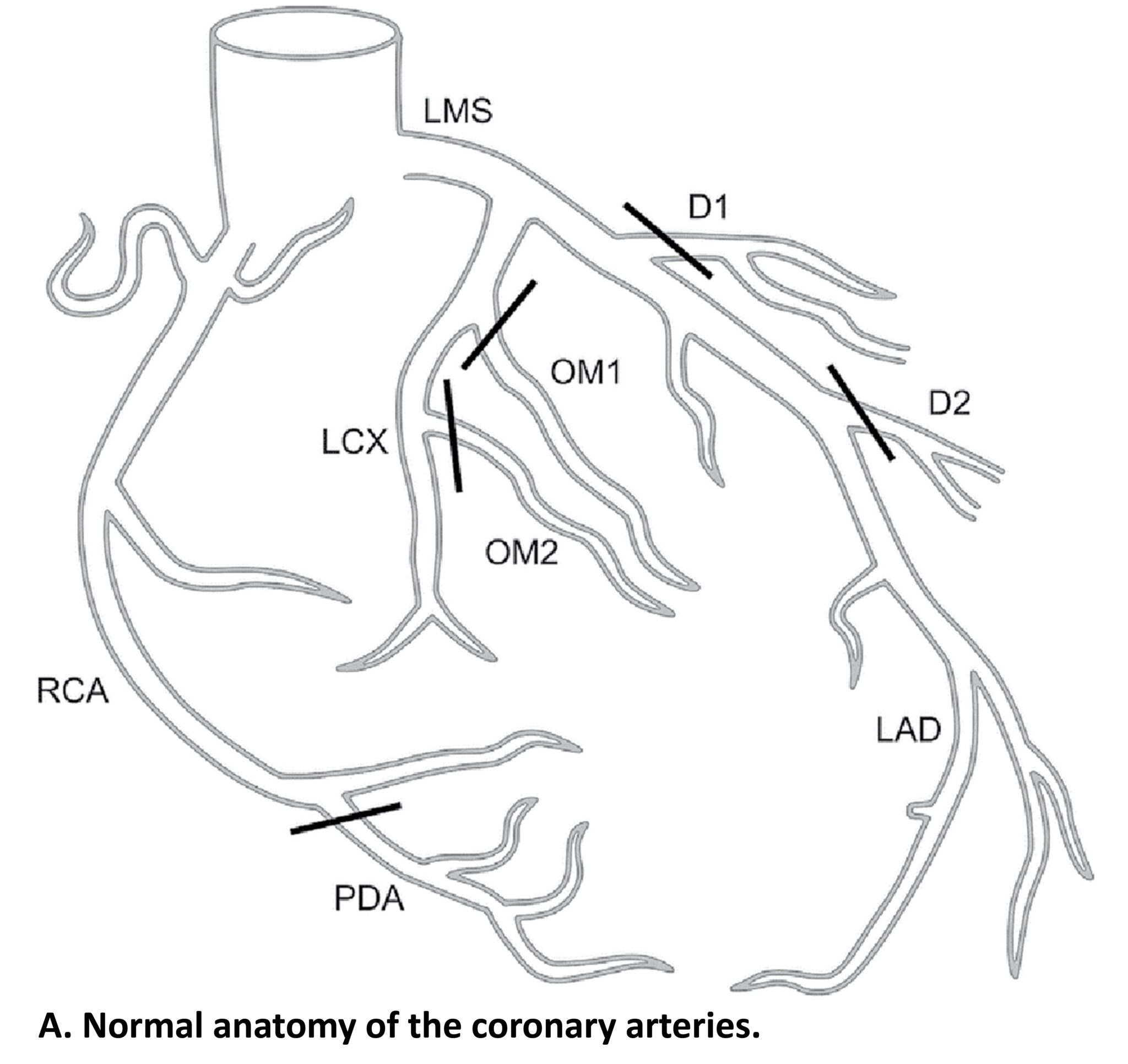 NSTEMI in 50-year-old Filipino Male with an Absent Left Main Coronary ...