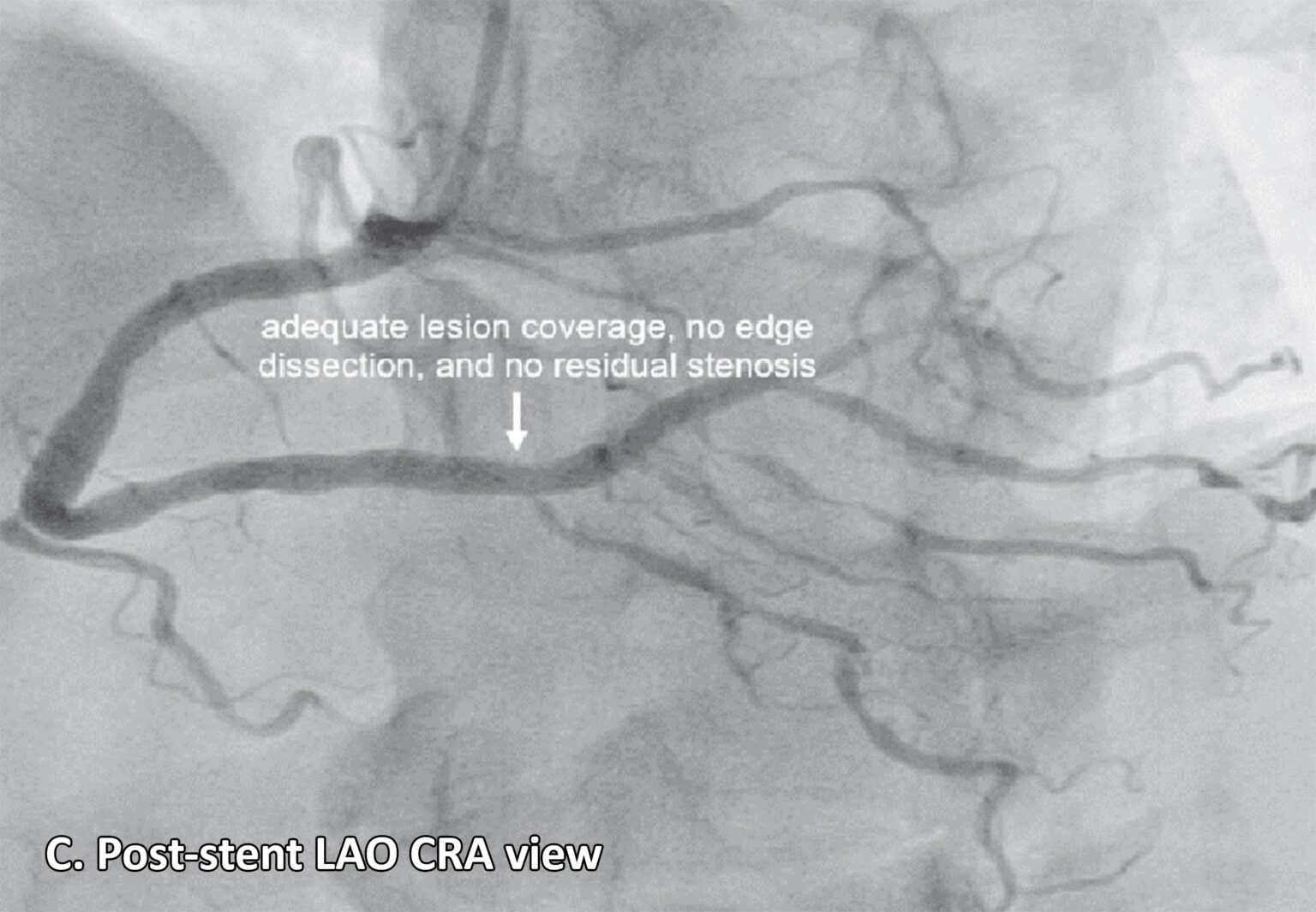 NSTEMI in 50-year-old Filipino Male with an Absent Left Main Coronary ...