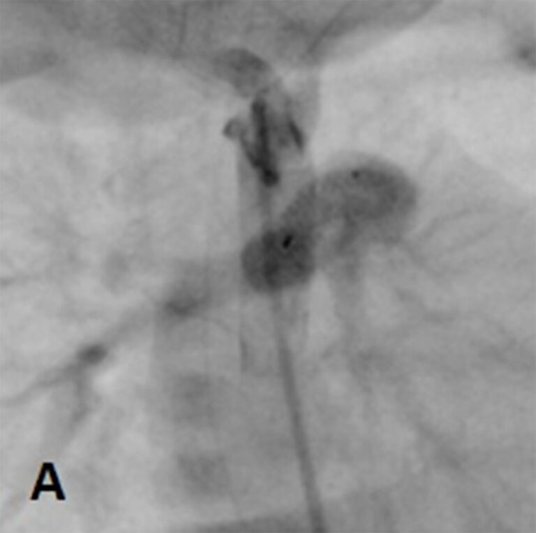 Case Report: Downsizing Patent Ductus Arteriosus Stent using a Modified ...