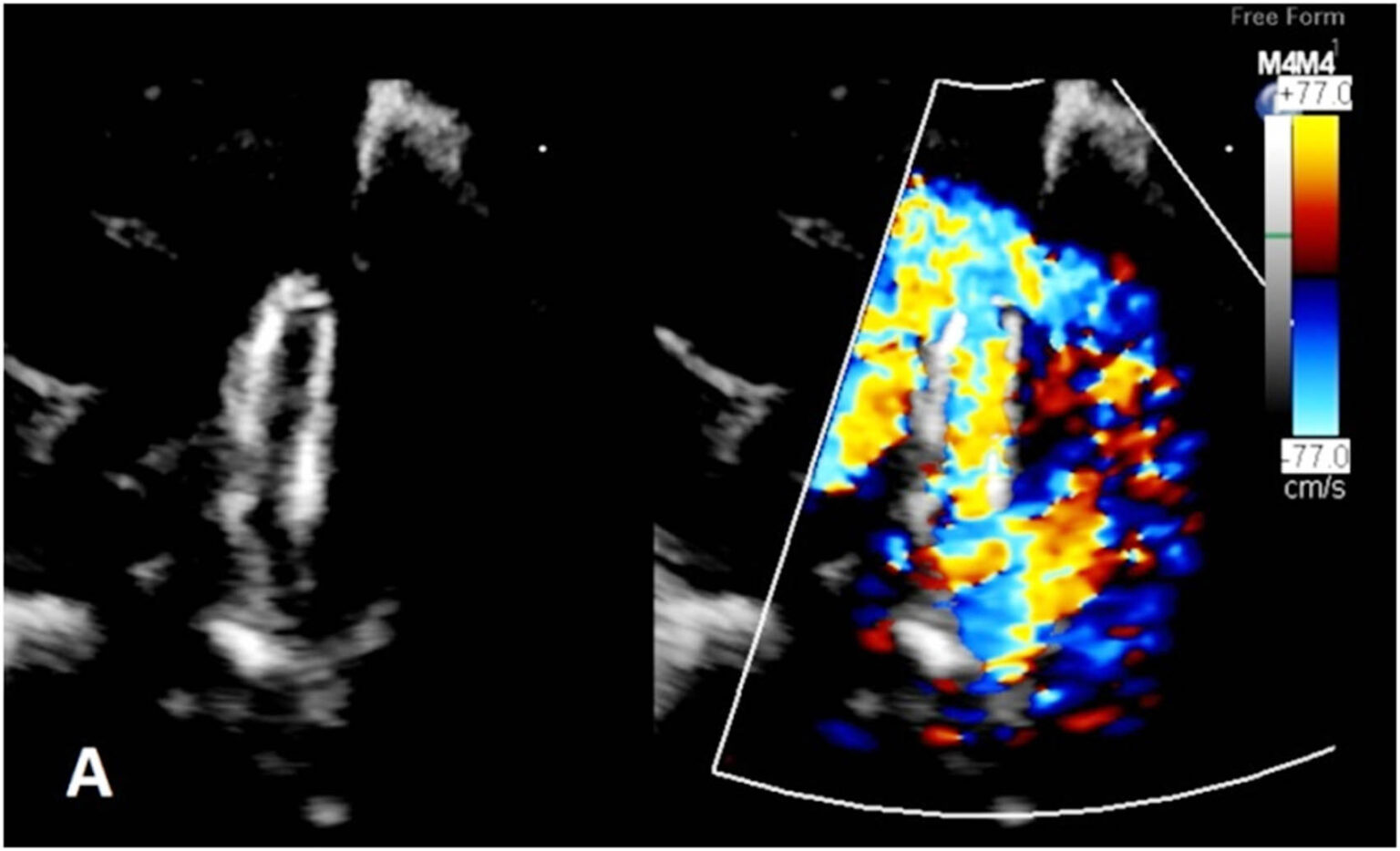 Case Report: Downsizing Patent Ductus Arteriosus Stent using a Modified ...