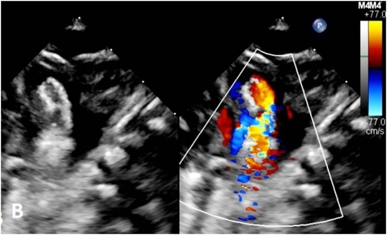 Case Report: Downsizing Patent Ductus Arteriosus Stent using a Modified ...