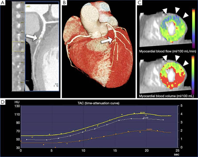 Coronary CT Angiography and Percutaneous Coronary Intervention: a Short ...